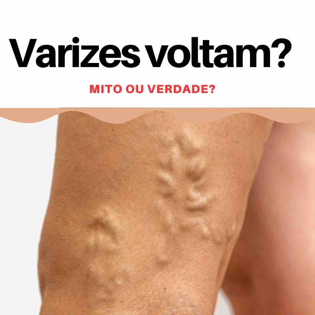 Vick Vaporub: funciona para varizes? - Dr. Ítalo Abreu