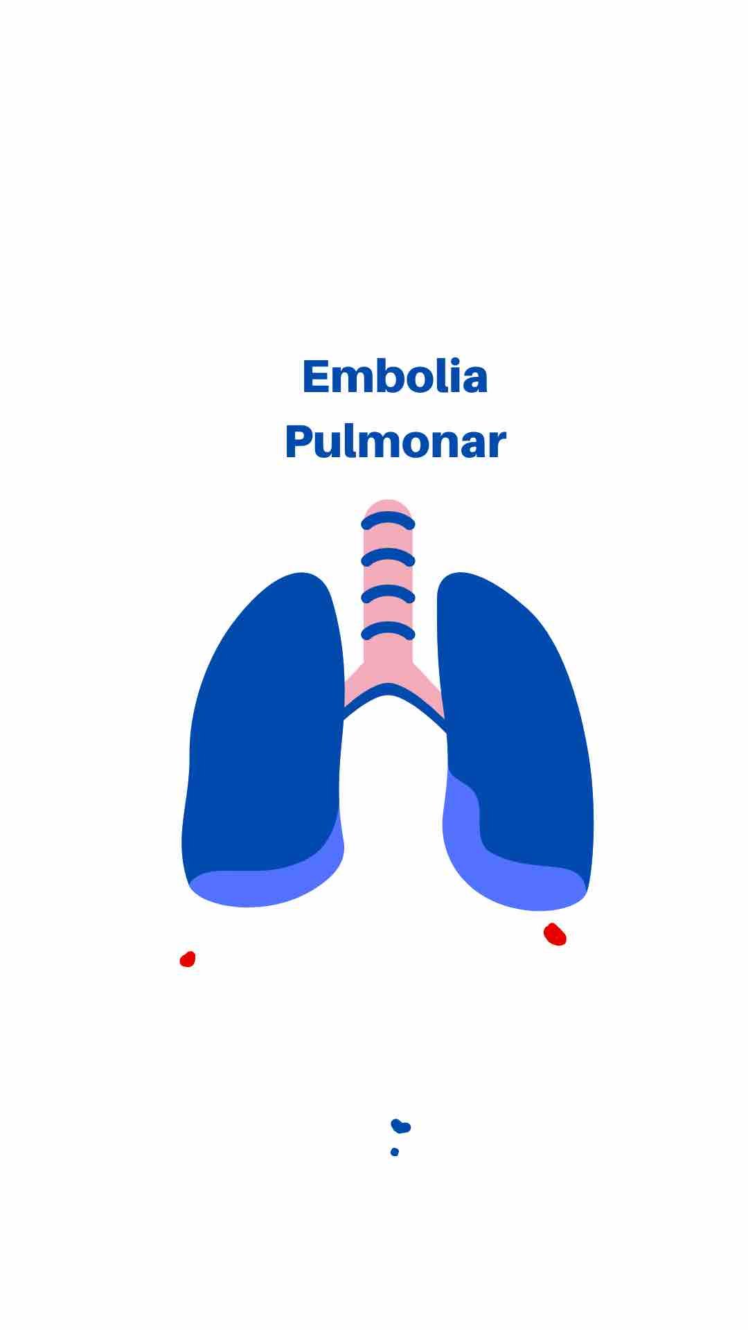Sinais de Embolia pulmonar e tratamento - Dr. Ítalo Abreu