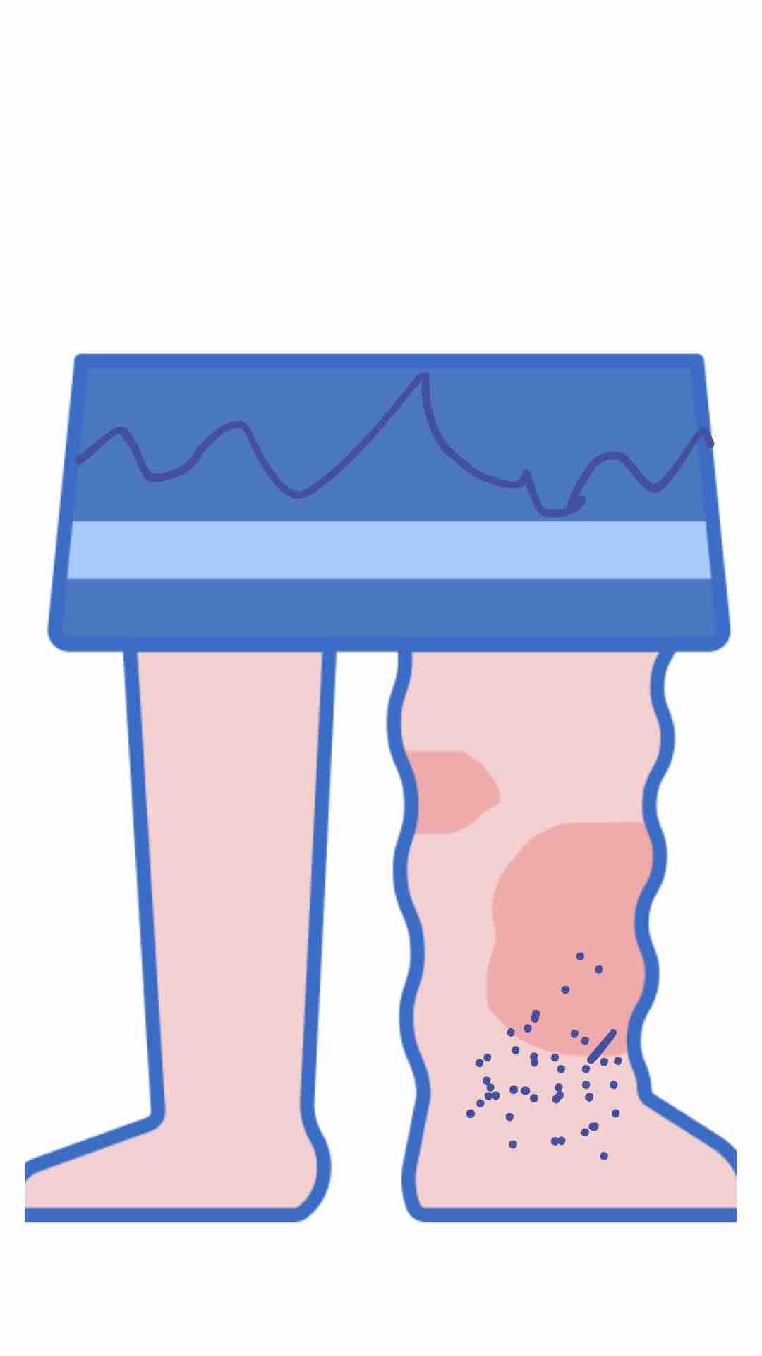 Dermatite ocre: Manchas escuras nas pernas - Dr. Ítalo Abreu